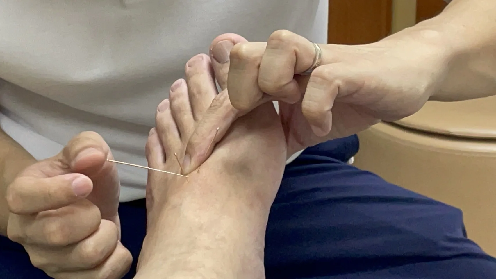 Experience the Healing Power of Dry Needling Physiotherapy in Thailand - Greenbell Clinic